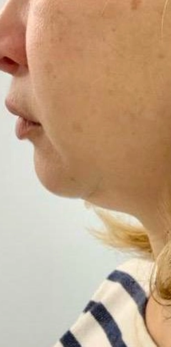 Double Chin Fat Dissolving in London | Bell Moon Aesthetics